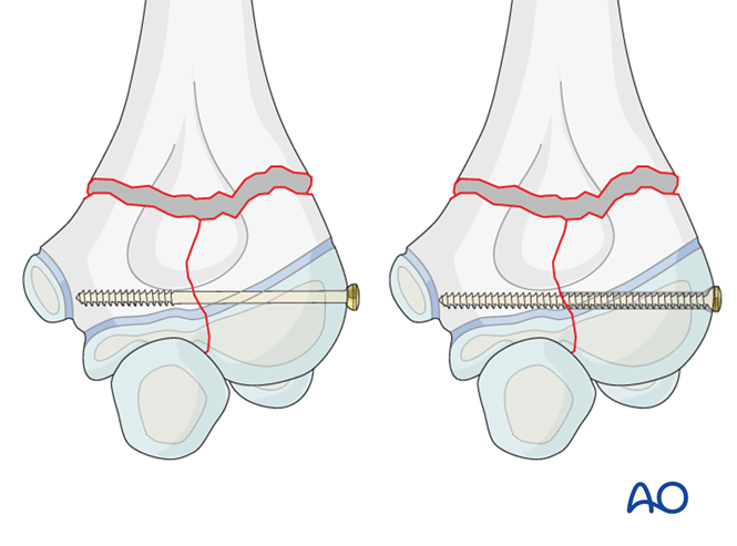 Open reduction; screw and plate fixation for Multifragmentary epi ...
