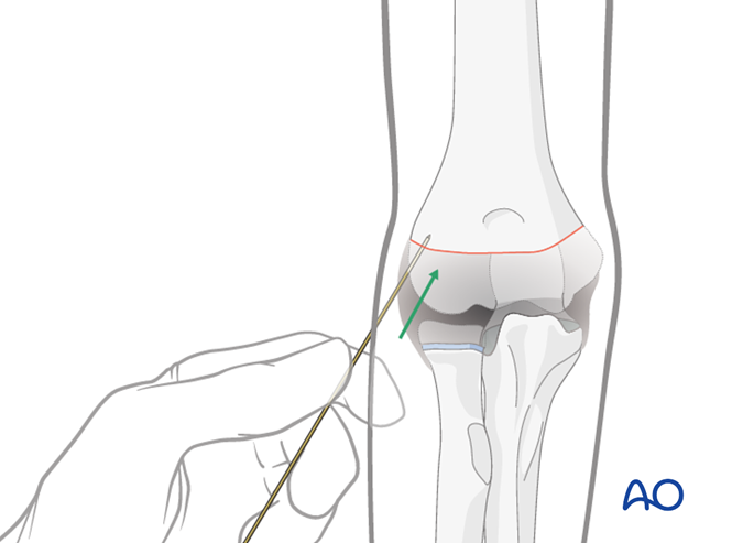 Closed reduction; K-wire fixation for Simple epiphysiolysis, SH I
