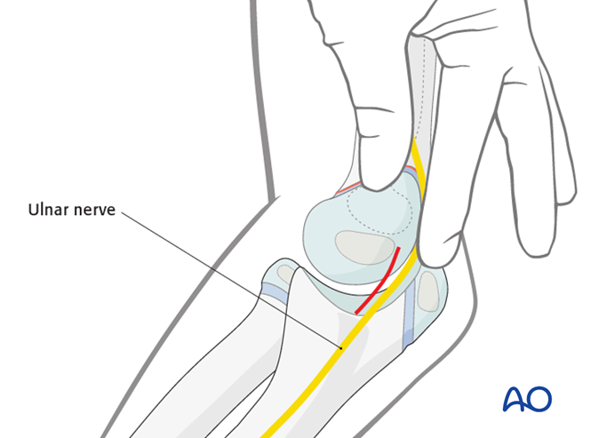 Closed reduction; K-wire fixation for Simple epiphysiolysis, SH I