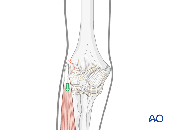 Open reduction; suture or suture and anchor fixation for Avulsion of/by ...