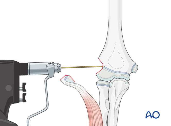 Open reduction; screw fixation for Avulsion of/by the lateral ...
