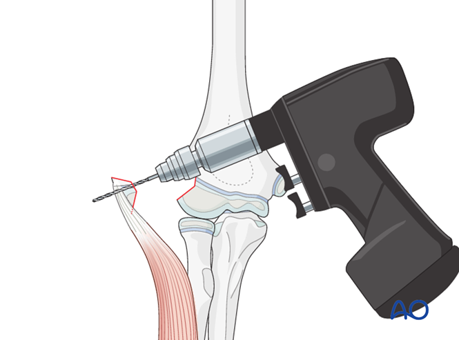 Open reduction; screw fixation for Avulsion of/by the lateral ...