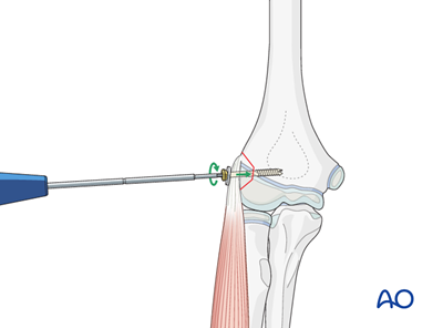 Open reduction; screw fixation for Avulsion of/by the lateral ...