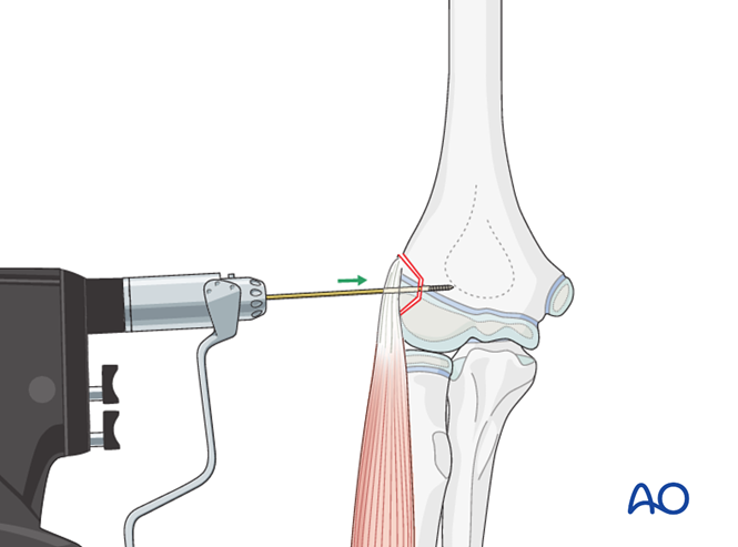 Open reduction; screw fixation for Avulsion of/by the lateral ...
