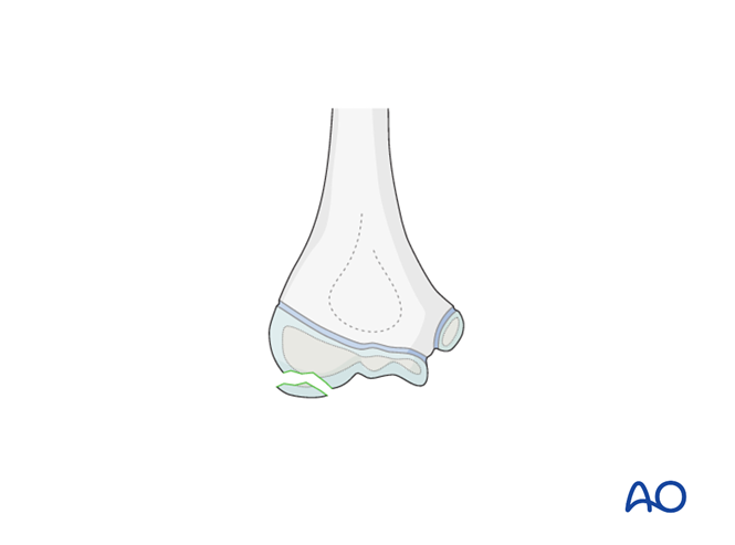 Arthrotomy and excision for Simple intraarticular flake