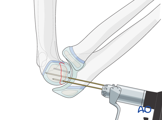 Open reduction; screw fixation for Simple intraarticular flake