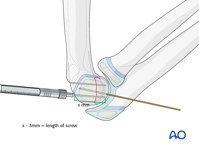 Open reduction; screw fixation for Simple intraarticular flake