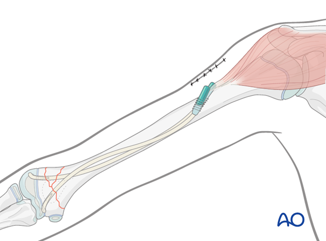 ESIN for Multifragmentary metaphyseal, complete with/without contact ...
