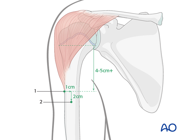 ESIN for Simple metaphyseal, complete with/without contact between ...