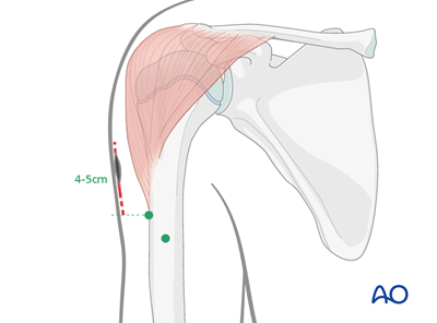 ESIN for Simple metaphyseal, complete with/without contact between ...