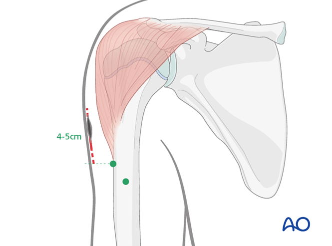 ESIN for Simple metaphyseal, complete with/without contact between ...