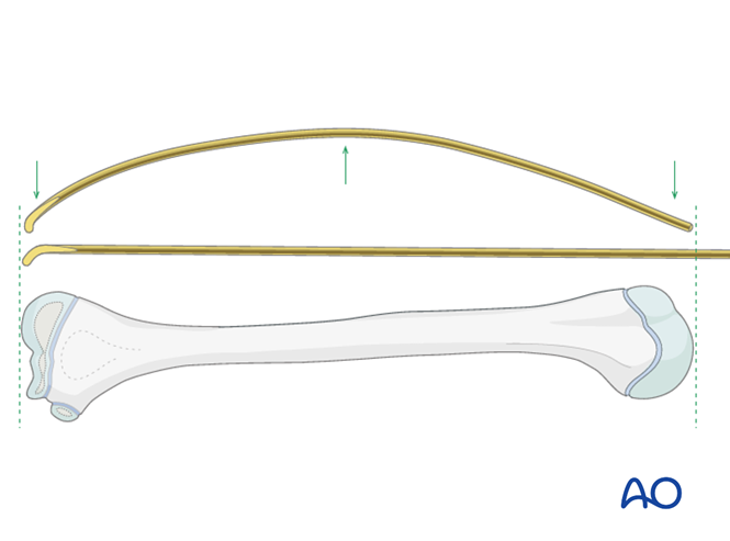 ESIN for Simple metaphyseal, complete with/without contact between ...