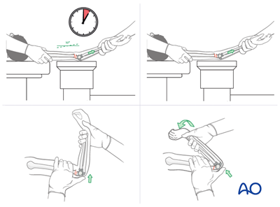 ESIN for Simple metaphyseal, complete with/without contact between ...