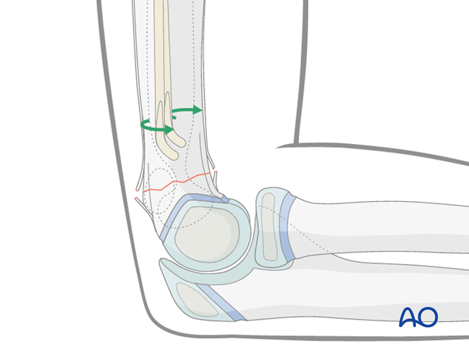 ESIN for Simple metaphyseal, complete with/without contact between ...