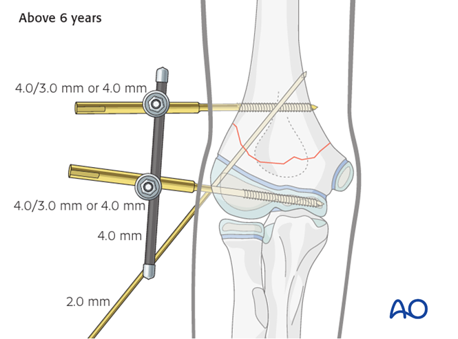 External fixator for Simple metaphyseal, complete with/without contact ...