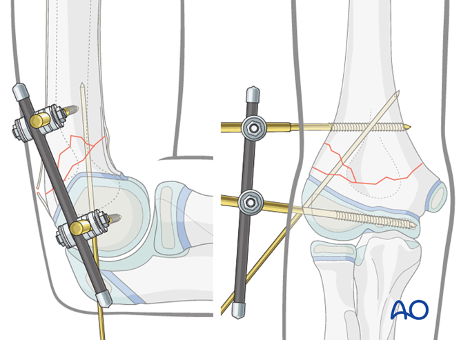 External fixator for Multifragmentary metaphyseal, complete with ...