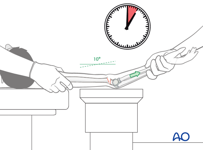 Closed reduction of supracondylar fractures