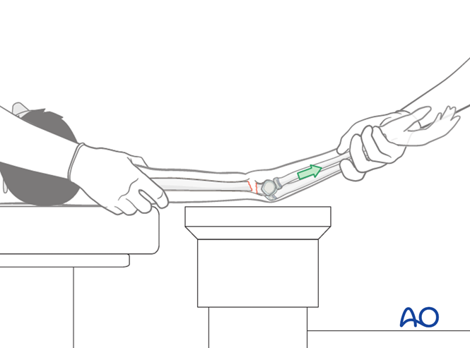 Closed reduction of supracondylar fractures