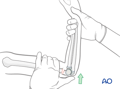 Closed reduction of supracondylar fractures