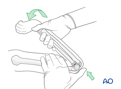Closed reduction of supracondylar fractures