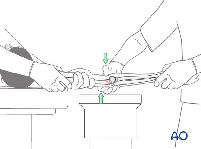 Closed reduction of supracondylar fractures