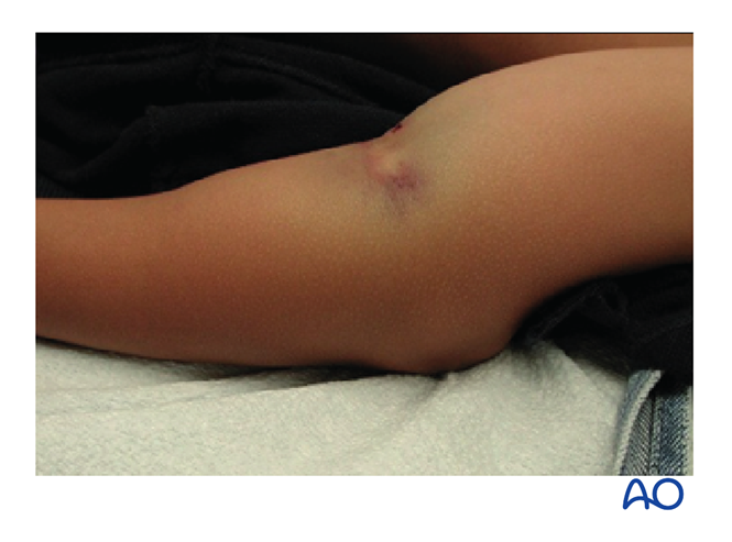 Closed reduction of supracondylar fractures