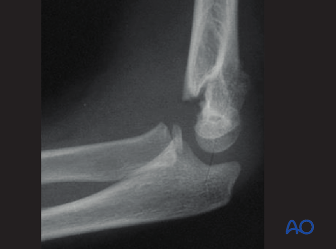 Closed reduction of supracondylar fractures