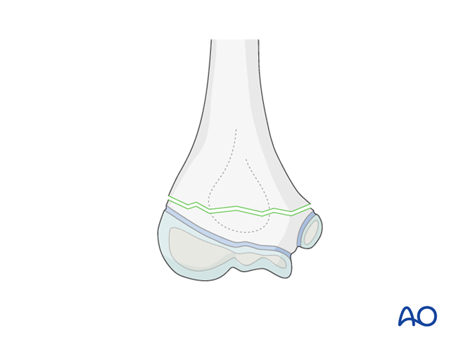 Timing of treatment of fractures of the distal humerus