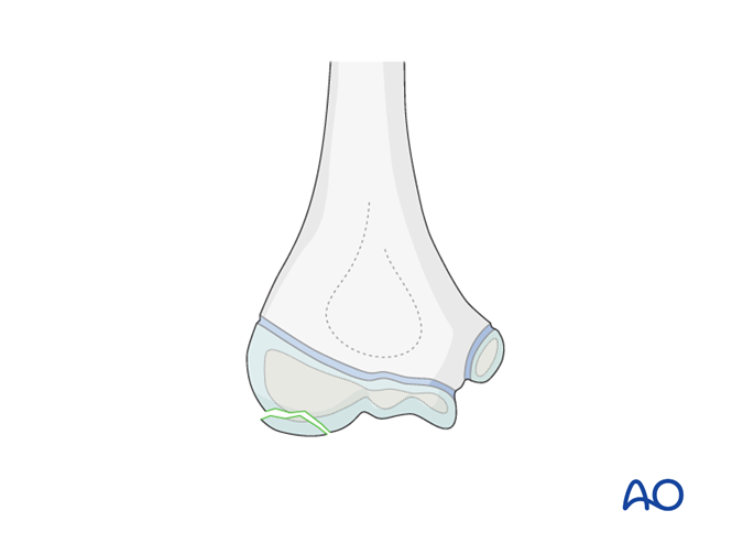 Timing of treatment of fractures of the distal humerus