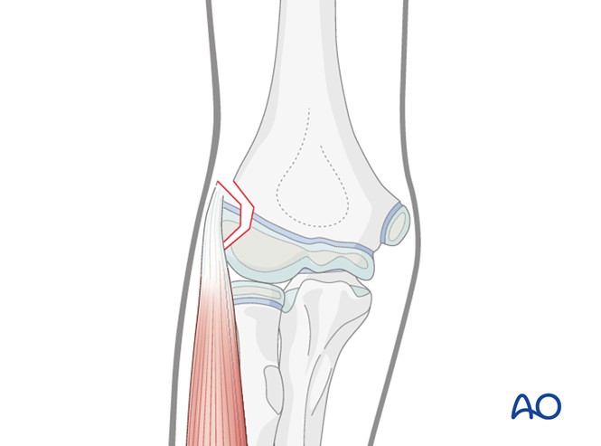 Timing of treatment of fractures of the distal humerus