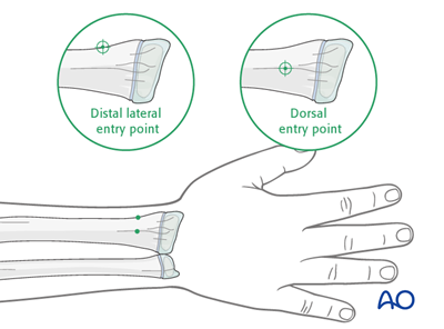 ESIN for Monteggia equivalent