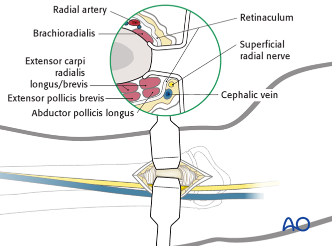 ESIN entry points (pediatric distal radius)