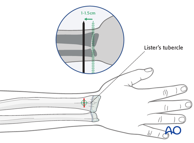 ESIN entry points (pediatric distal radius)