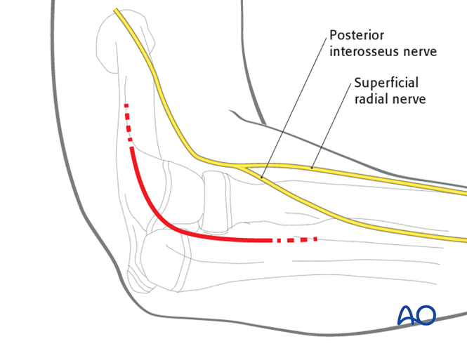 Lateral approach to the pediatric proximal radius