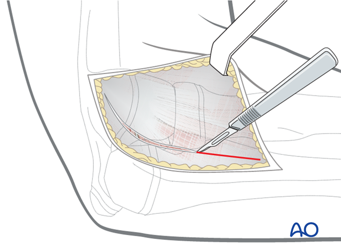Lateral approach to the pediatric proximal radius
