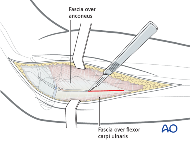 Posterolateral (Boyd) approach to the pediatric proximal radius and ulna