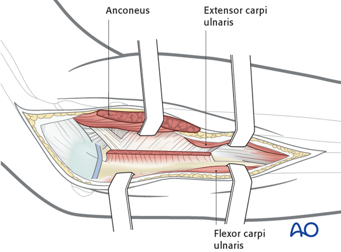 Posterolateral (Boyd) approach to the pediatric proximal radius and ulna