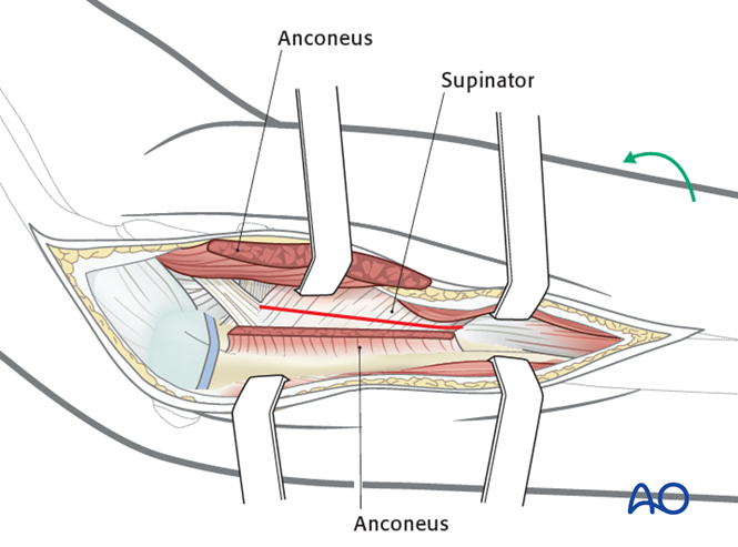 Posterolateral (Boyd) approach to the pediatric proximal radius and ulna