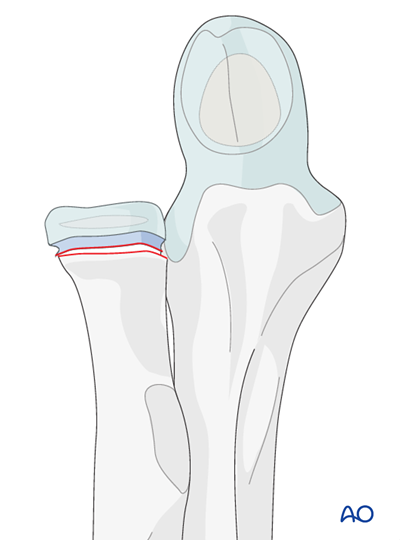 Radius, epiphysiolysis, SH I