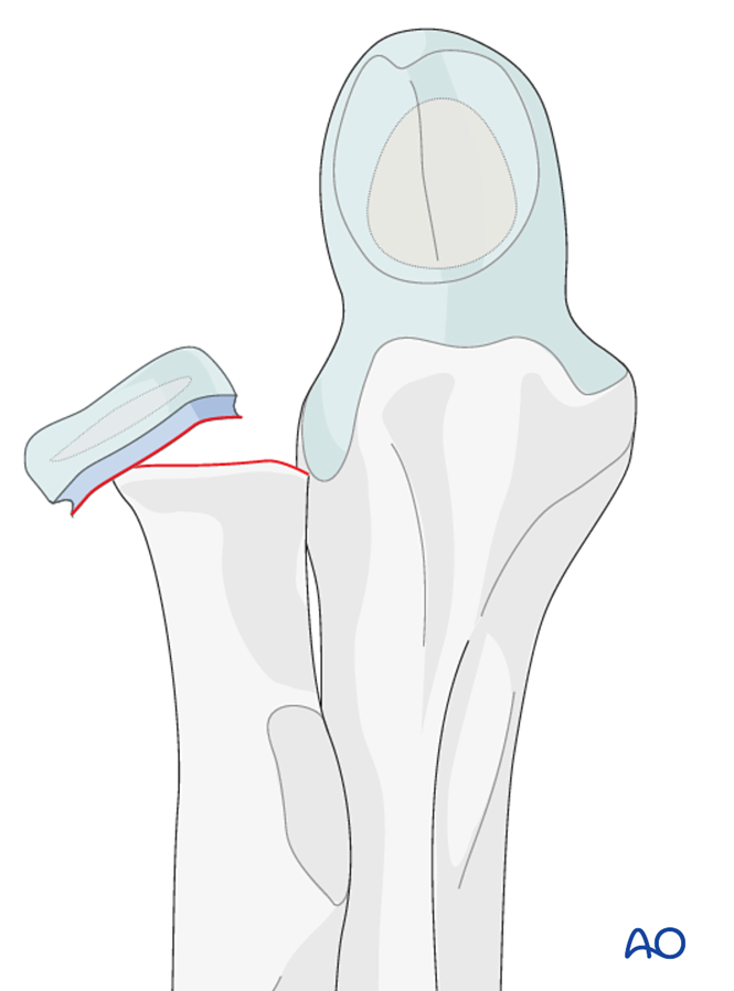 Radius, epiphysiolysis, SH I
