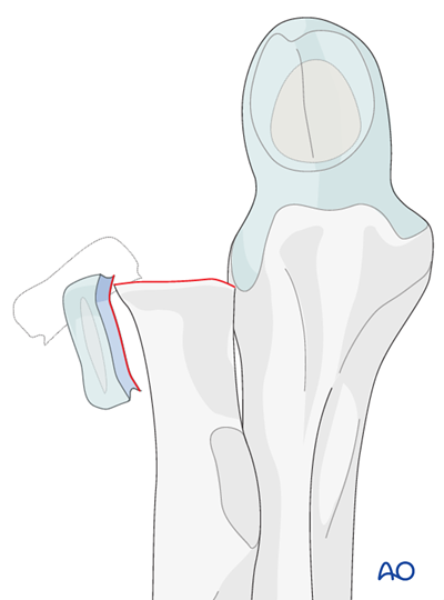 Radius, epiphysiolysis, SH I