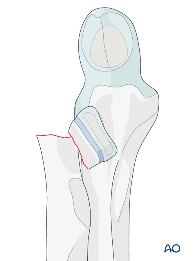 Radius, metaphyseal, complete