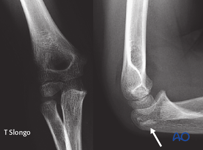 Radius, epiphysiolysis with metaphyseal wedge, SH II