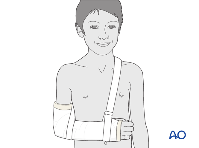 Immobilization with a cast