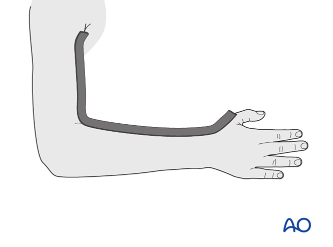 Immobilization with a cast
