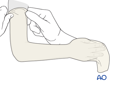 Immobilization with a cast