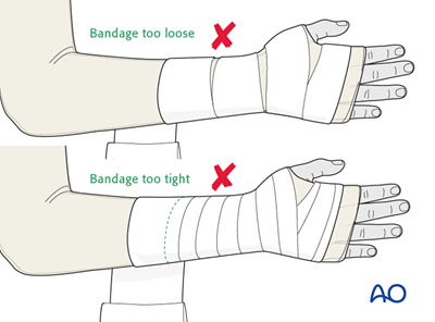 Immobilization with a cast