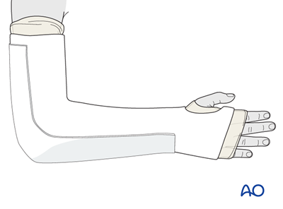 Immobilization with a cast