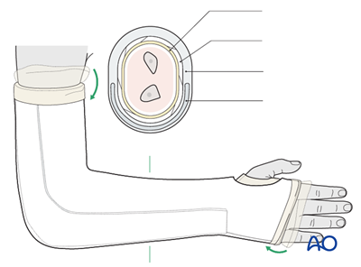 Immobilization with a cast