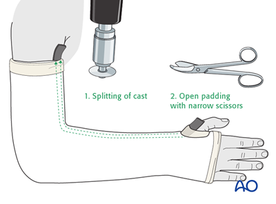 Immobilization with a cast